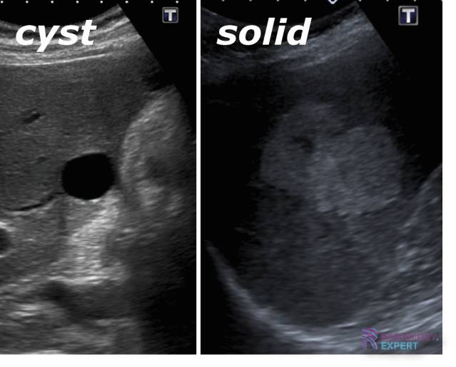 Abdominal Ultrasound